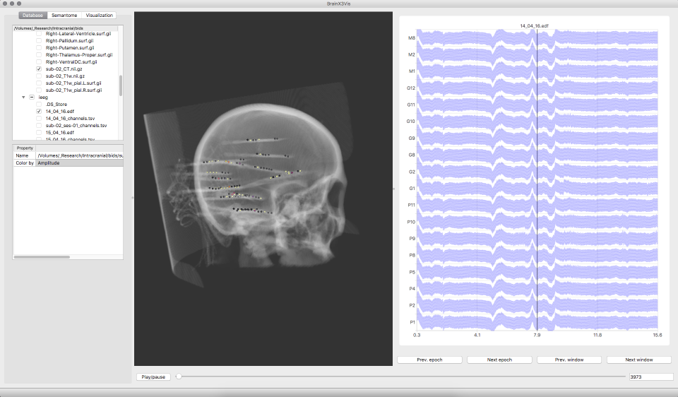 BrainX3 » Intracranial recordings